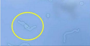 Seeing Spots? Here's What You Should Know