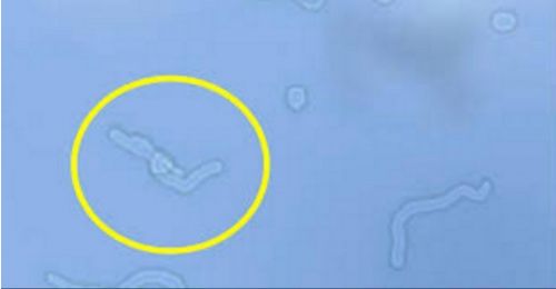 Seeing Spots? Here's What You Should Know